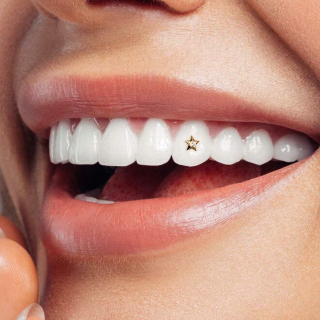 Bleaching / Zahnaufhellung im smilestore Studio - Essen